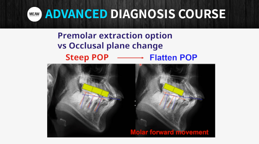 7. PREMOLAR EXTRACTION TREATMENT